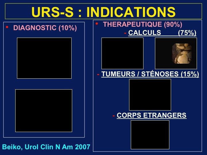 Urofrance | Communications orales - Lithiase : urétéro-rénoscopie ...