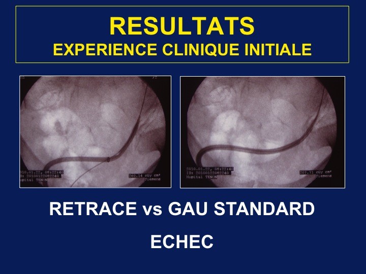 Urofrance | Communications orales - Lithiase : urétéro-rénoscopie ...