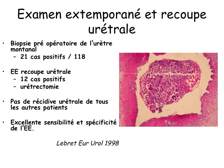 Urofrance | Le point sur l'extemporanée en urologie - Urofrance