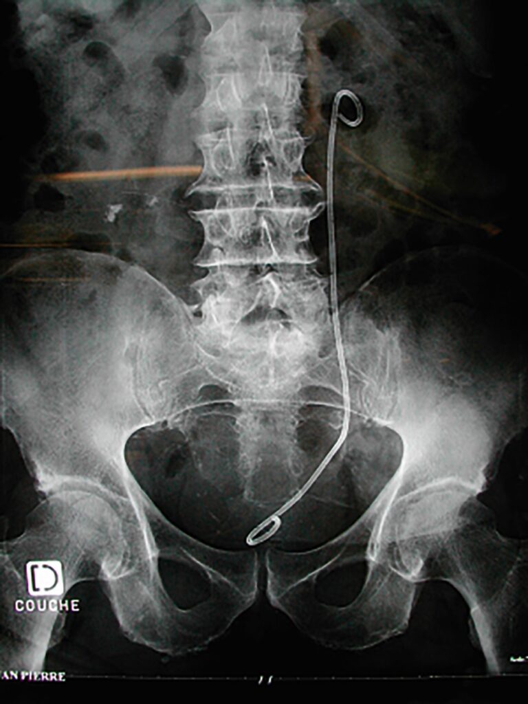 Urofrance | CHAPITRE 14 Item 265 – Lithiase urinaire - Urofrance