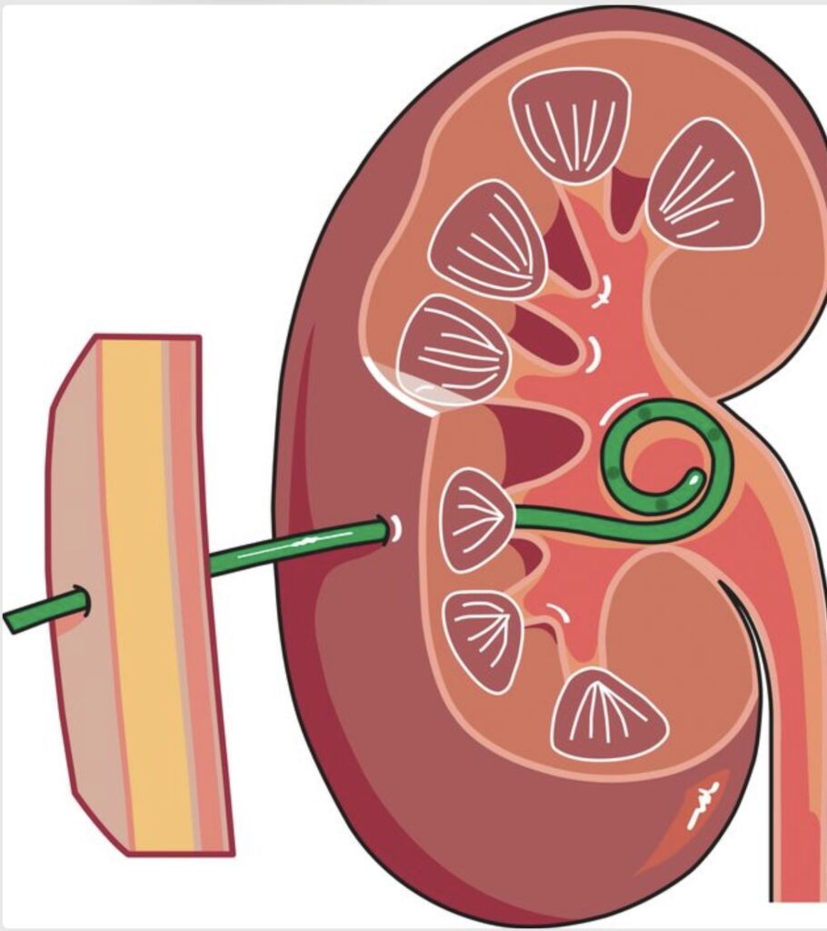 Urofrance | CHAPITRE 14 Item 265 – Lithiase urinaire - Urofrance