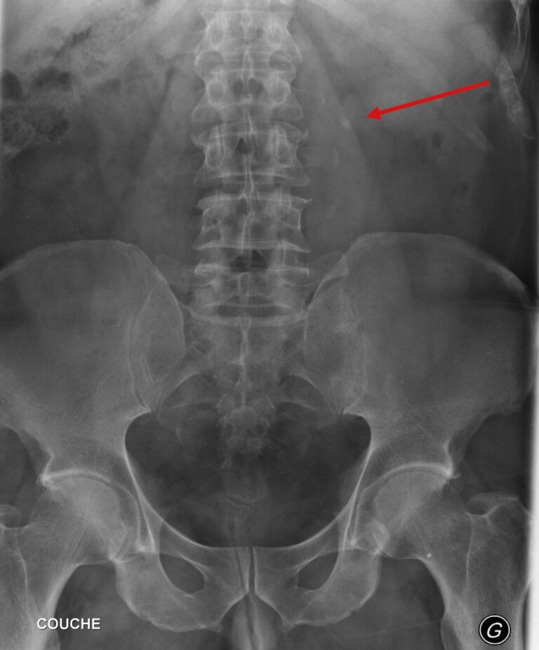 Urofrance | CHAPITRE 14 Item 265 – Lithiase urinaire - Urofrance