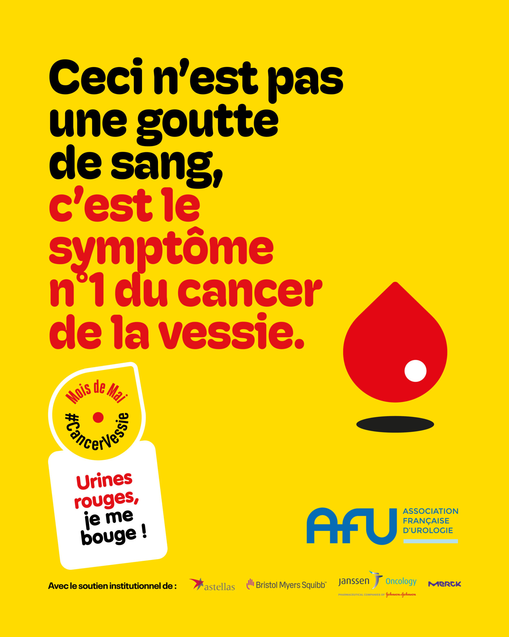 Urofrance | Cancer de la vessie - Urofrance