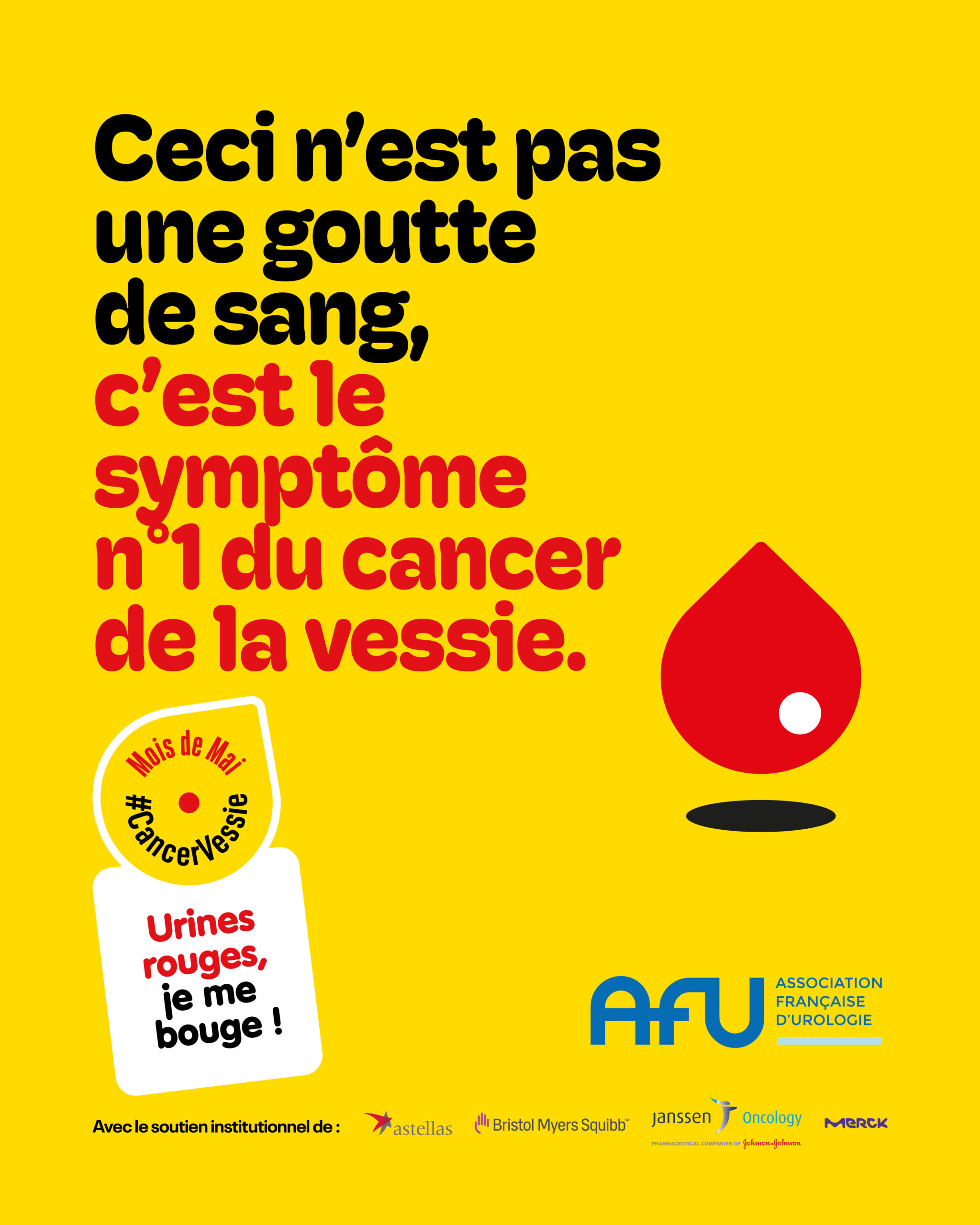 Urofrance | Cancer de la vessie - Urofrance